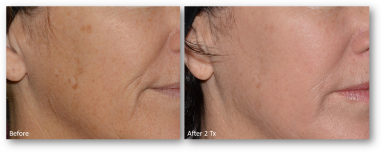 Laser Skin Resurfacing Jacksonville, FL |Laser Facial Near Me