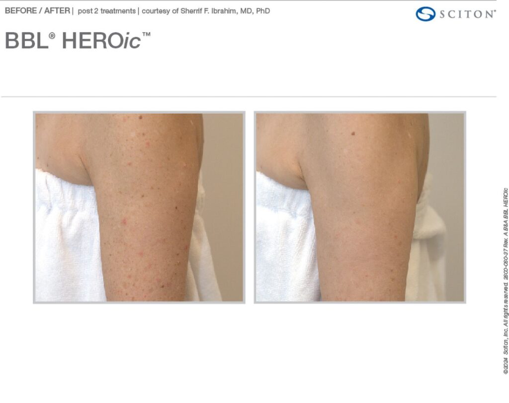 BBL HERO Jacksonville, FL | BroadBand Light Skin Rejuvenation Near Me