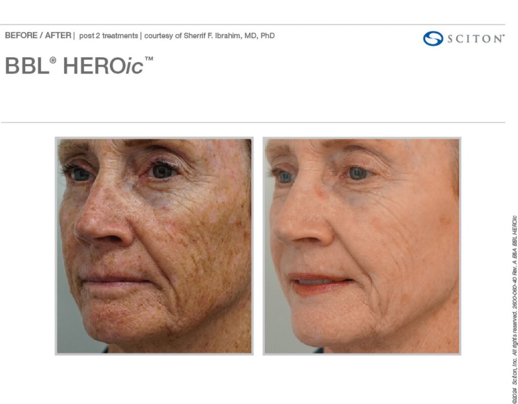 BBL HERO Jacksonville, FL | BroadBand Light Skin Rejuvenation Near Me