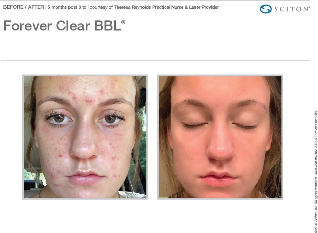 BBL HERO Jacksonville, FL | BroadBand Light Skin Rejuvenation Near Me