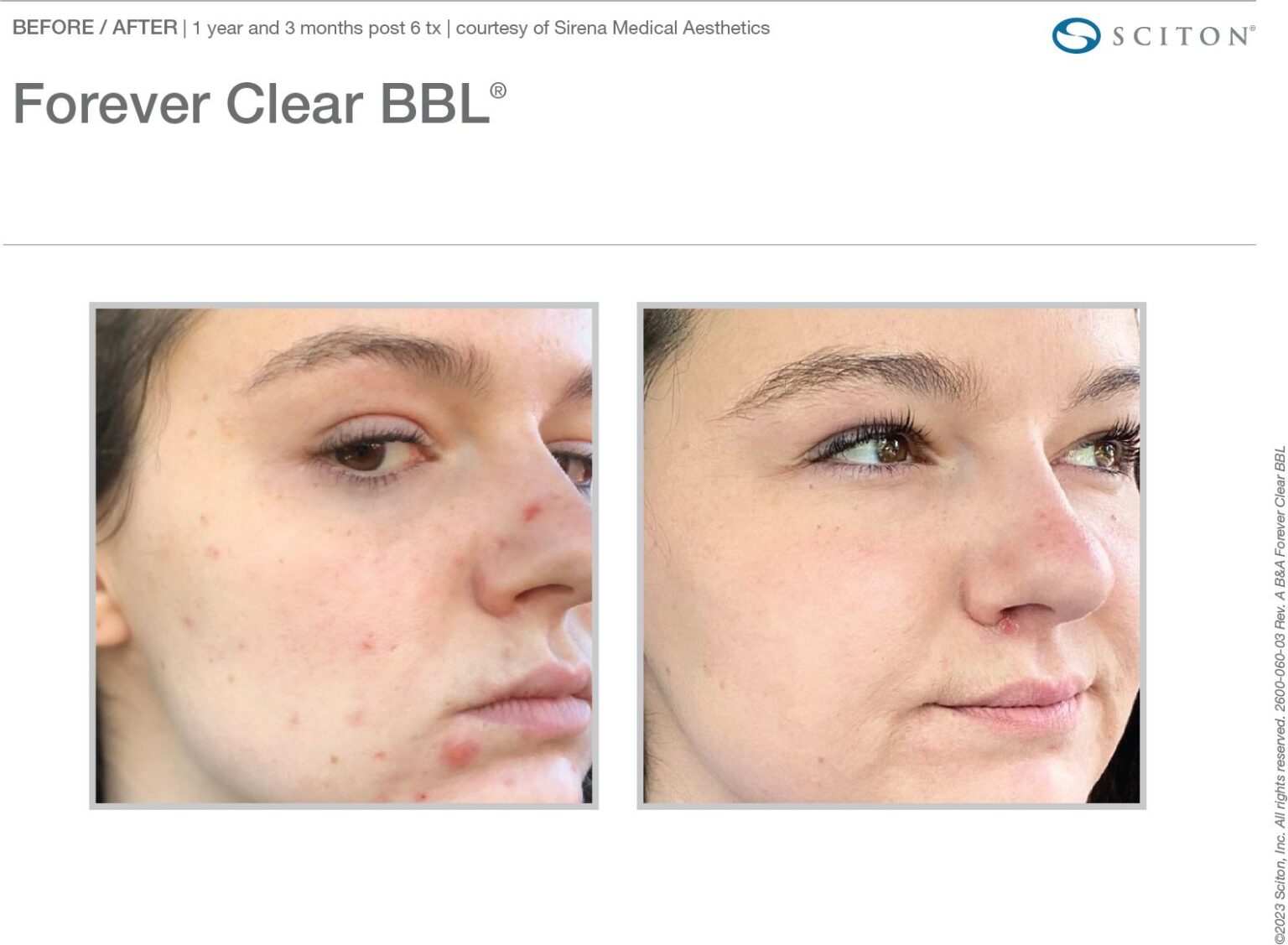 BBL HERO Jacksonville, FL | BroadBand Light Skin Rejuvenation Near Me