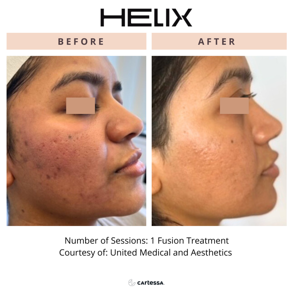 CO2 Laser Resurfacing Jacksonville, FL | Near Me