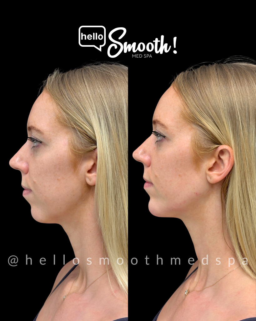 Chin Filler | Hello Smooth Med Spa